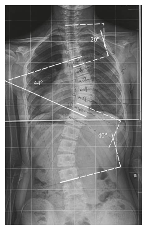 Cobb Angle Measurement Method Download Scientific Diagram