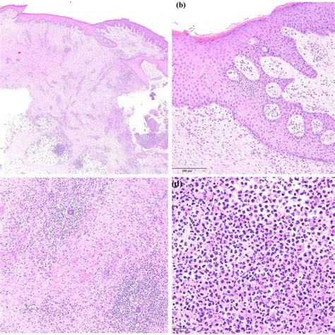 A Female Patient With Pyoderma Gangrenosum Plaque Psoriasis And