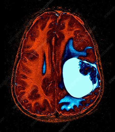 Colour Enhanced Primitive Neuroectodermal Tumour Pnet Mri Stock