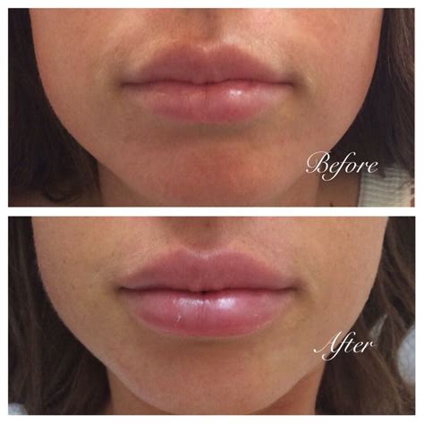 Pin By Kiley Theodore On Filler Face Lip Fillers Lip Augmentation