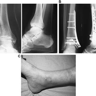 A Articular Fracture Of The Distal Tibia In A Year Old Man B Download Scientific