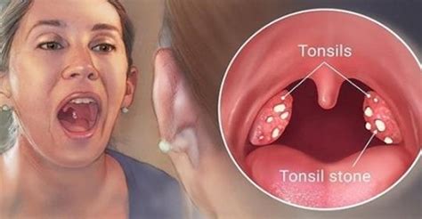 Сливици възпалени и подути Лечение или вадене Лекар БГ