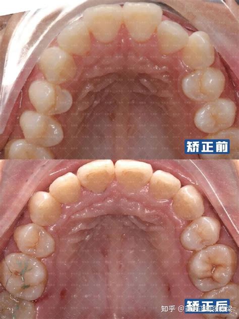 北京牙齿矫正 大龄正畸嘴凸下巴后缩换头式整牙 知乎
