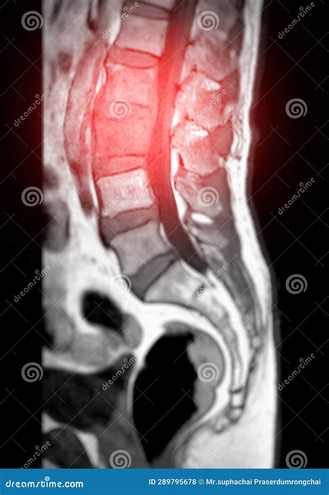 Mri L S Spine Or Lumbar Spine Sagittal T1 Technique For Diagnosis