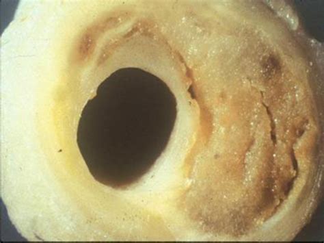 Pathophysiology Of Atheroma Flashcards Quizlet