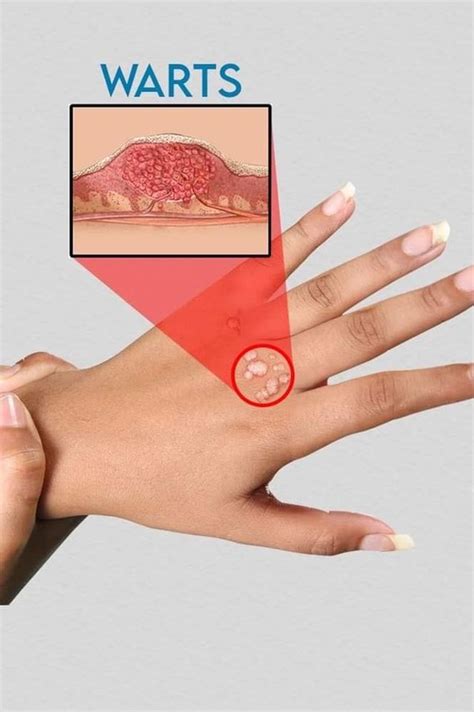 Wartscure Did You Know That A Wart Is A Small Growth With A Rough
