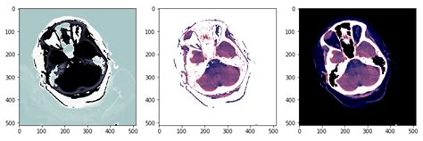 Detecting And Classifying Intracranial Hemorrhage By Kelly Zhang Medium