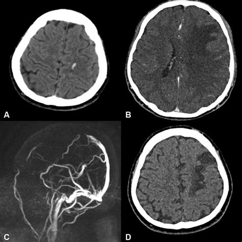 Example Of Herniated Case With Juxtacortical Hemorrhage On Download Scientific Diagram