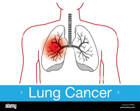 Types Of Lung Cancer Stock Vector Images Alamy