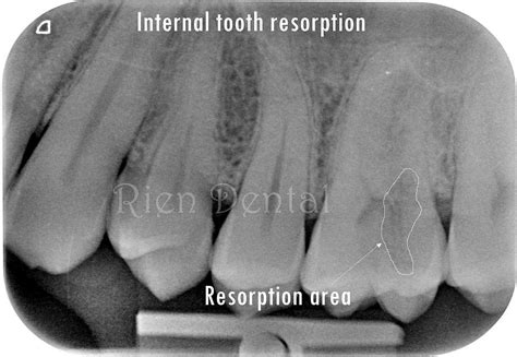 Internal Tooth Resorption Root Canal Treatment With 5 Canals