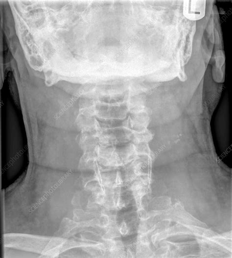 Normal Cervical Spine X Ray Stock Image C0197229 Science Photo