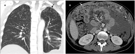 Mother A Chest Ct Coronal View Demonstrating Tree In Bud Pattern In Download Scientific