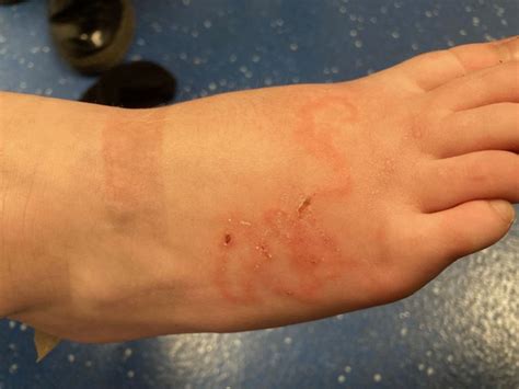 Skin Symptoms Parasitic Infections