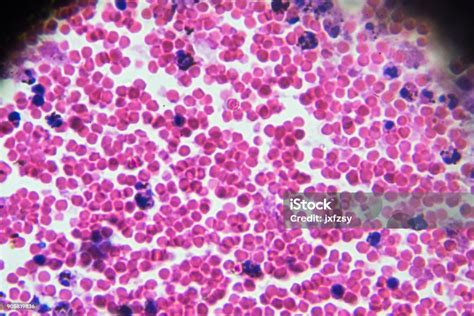 Acute Phlegmonous Appendicitis Pathology Under Light Microscopy Stock