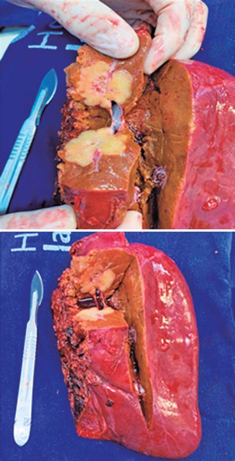 Simultaneous Embolization Of The Right Portal And Hepatic Veins Before Intrahepatic