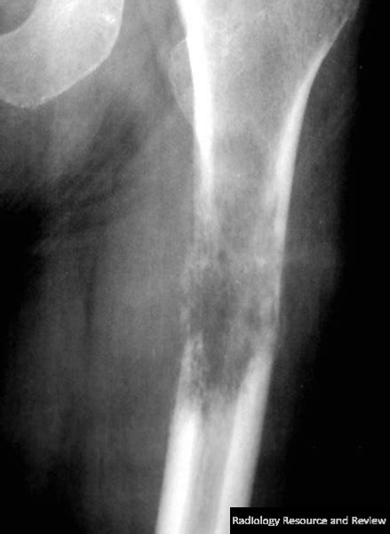 Learningradiology Pathologic Fracture Pathological Malignancy Metastasis Bone Radiology