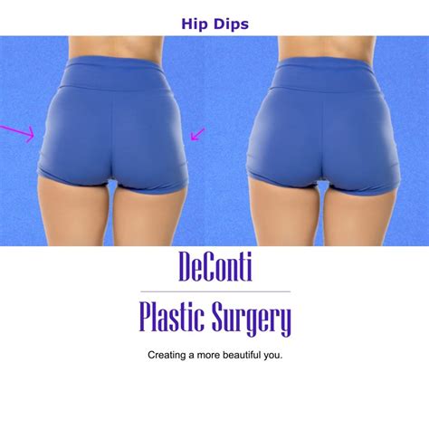 Fat Grafting For Hip Dips Deconti Plastic Surgery