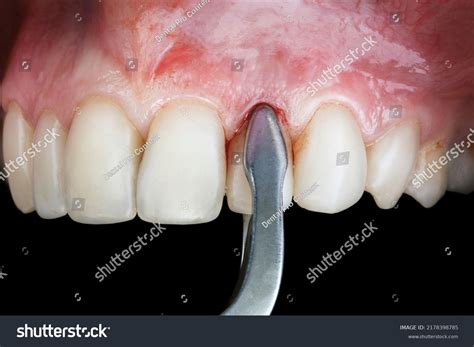 What Is A Tooth Elevator At Hee Slocum Blog