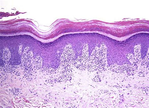 Histopathologic Features Distinguishing Secondary Syphilis From Its