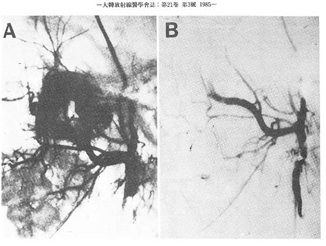 Figure 2 From Transarterial Embolization In Head And Neck Lesions Semantic Scholar
