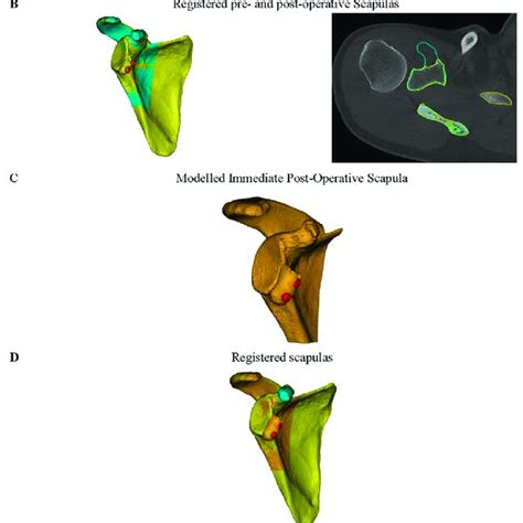 A Computed Tomography Ct Scans Were Digitally Segmented Using