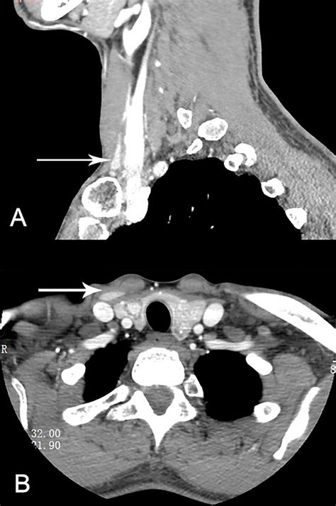Ectopic Lateral Thyroid In Ct As Is Shown In White Arrow In A And B Download Scientific Diagram