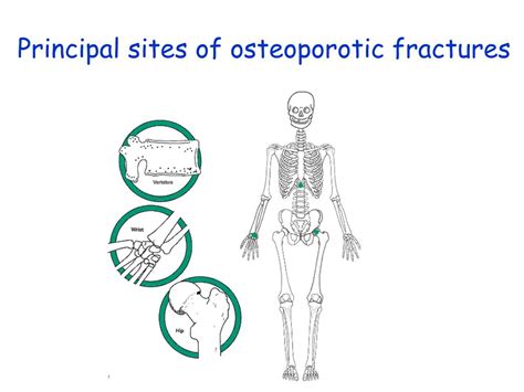 Ppt The Frax Tool For Osteoporosis Should All Gps Be Calculating The Ppt The Frax Tool For Osteoporosis Should All Gps Be Calculating The
