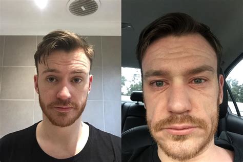 Swollen Face Allergy