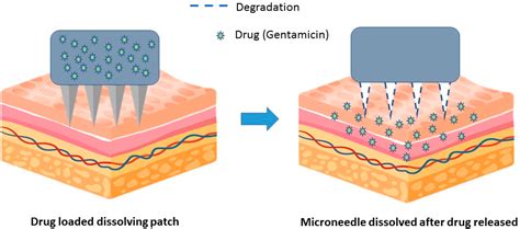 Recent Advancement Of Medical Patch For Transdermal Drug Delivery