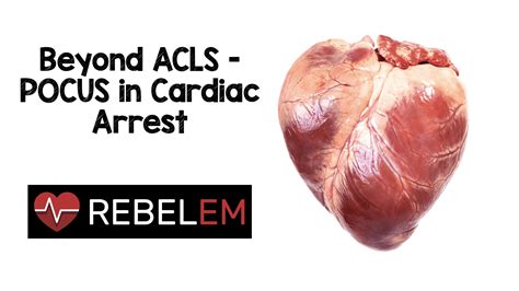 Beyond Acls Pocus In Cardiac Arrest Rebel Em Emergency Medicine Blog