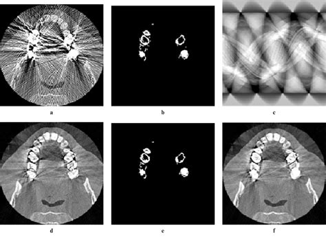 Figure 1 From Dental Ct Metal Artefact Reduction Based On Sequential Substitution Semantic