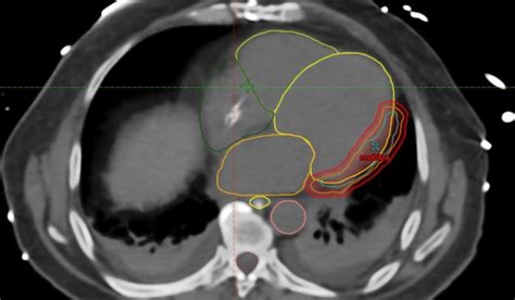 The San Carlos Clinical Hospital Uses Radiotherapy For The Treatment Of Ventricular Storm San