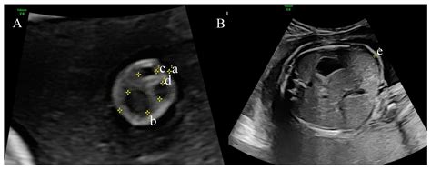 Umbilical Cord Biometry And Fetal Abdominal Skinfold Assessment As Potential Biomarkers For