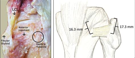Proximal Tib Fib Dislocation Knee And Sports Orthobullets Proximal Tib Fib Dislocation Knee And Sports Orthobullets