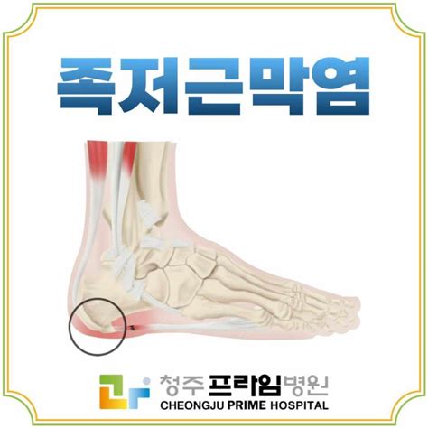 조치원정형외과 운동 후 발바닥 통증 방치하면 만성화될 수 있어 네이버 블로그