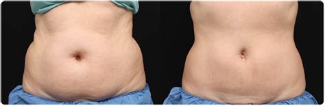 Belly Fat Surgery