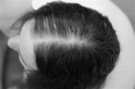 Shah Hair Clinic London Female Hair Loss Solutions