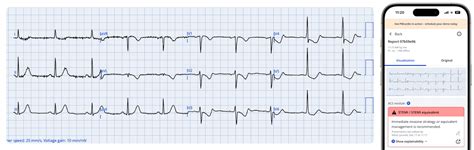 Advanced Stemi Detection And Improved Cath Lab Activation Through