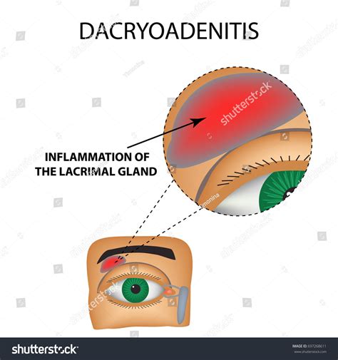 Dacryoadenitis Inflammation Lacrimal Gland Structure Eye Stock Vector Royalty Free 697268611