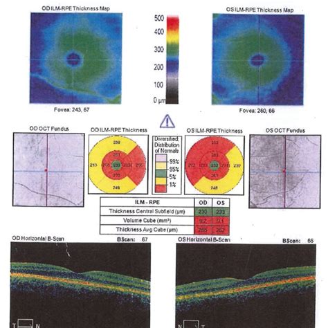 Macular Oct Scan With Macular Thickness Map Both Eyes Download