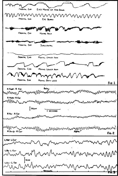 Figure 1 From The Human Electroencephalogram And Its Clinical Significance Semantic Scholar