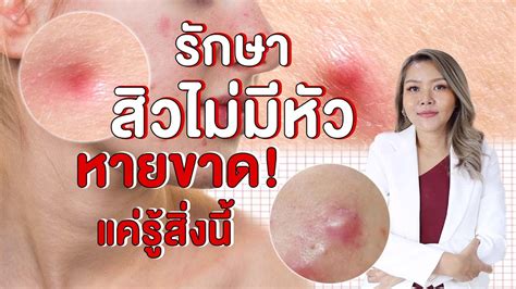 กูรูชวนเช็ค รักษาสิวไม่มีหัว หายขาด แค่รู้สิ่งนี้ Youtube