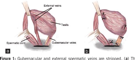 Figure 2 From Microsurgical Subinguinal Varicocelectomy With Spermatic