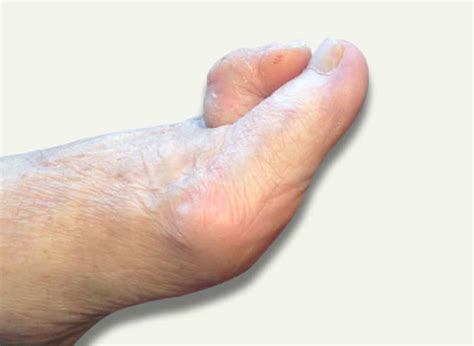 Mallet Toe Davenport House Clinic