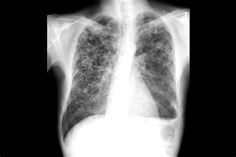 Mycobacterium Tuberculosis Infection Clinical Advisor