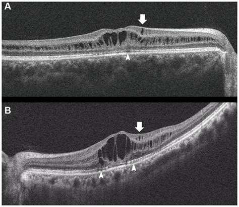 Frontiers Optical Coherence Tomography Findings Of The Peripheral