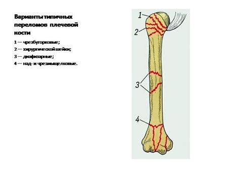 Перелом плечової кістки