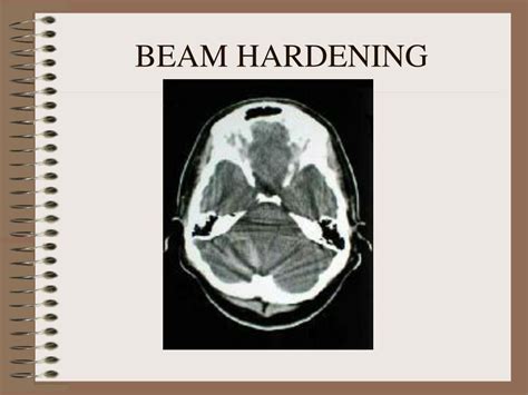Beam Hardening Artifact Ct Scan The Best Picture Of Beam