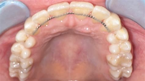 Orthodontic Retainers Albury Wodonga Orthodontics