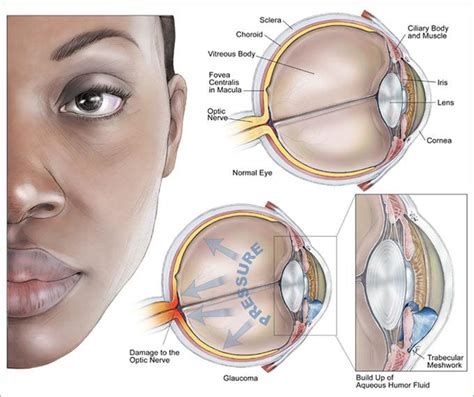 Glaucoma Glaucoma Question And Answers Firmoo Answers